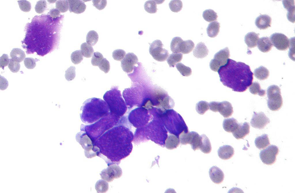 Difference Between Adenoma and Carcinoma | Definition, Types, Causes ...