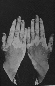 Difference Between Vitiligo and Leucoderma | Clinical Features, Causes ...