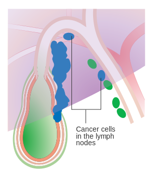 How Do Cancer Cells Spread | Cancer Cells, Growth, Mode of Spread