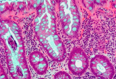 Difference Between Cyst and Polyp | Features, Causes, Symptoms ...