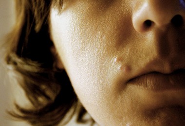 Difference Between Zit and Pimple | Features, Causes, Management and ...