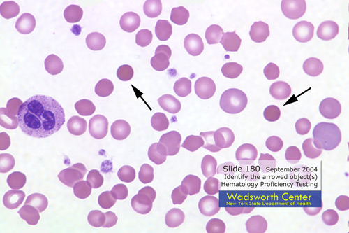 Difference Between SS and SC Genotype | Definition, Characteristics ...