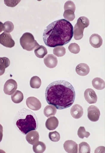 What Is The Difference Between Myeloblast And Lymphoblast Pediaacom
