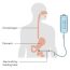 What is the Difference Between Enteral and Parenteral Feeding - Pediaa.Com