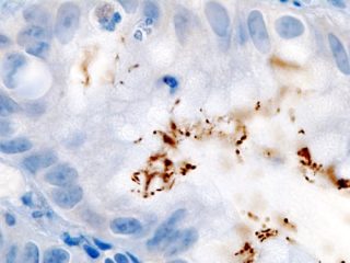 What is the Difference Between H. Pylori IGG and IGA - Pediaa.Com