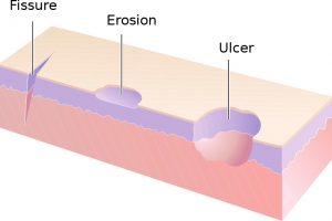 What is the Difference Between Fissure and Fistula – Pediaa.Com
