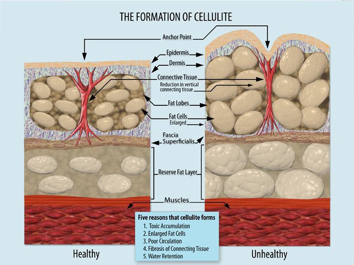 What is the Difference Between Cellulite and Fat - Pediaa.Com