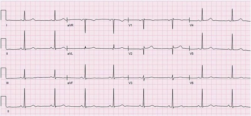 What is the Difference Between Bradycardia and Tachycardia - Pediaa.Com