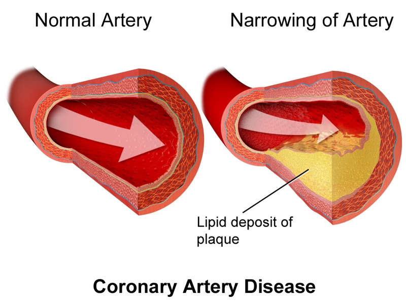 What is the Difference Between Plaque and Calcification - Pediaa.Com