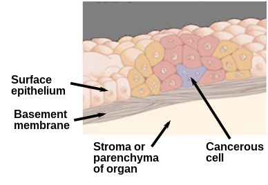 What is the Difference Between Neoplasm and Neoplasia - Pediaa.Com