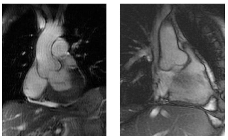What is the Difference Between Aortic Dilation and Aneurysm - Pediaa.Com